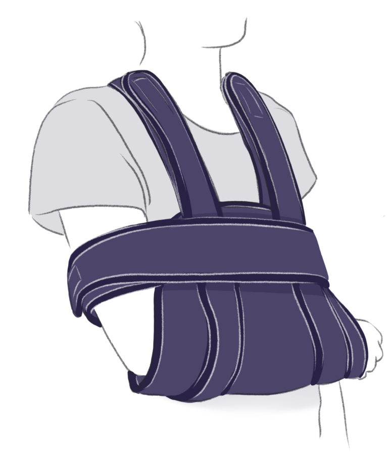 Disjonction acromio claviculaire - Chirurgie de l’épaule et du Coude